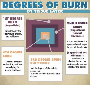 Infographic: Degrees of burn by tissue layers - StudyPK