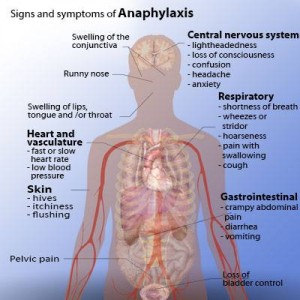 Signs and Symptoms of Anaphylaxis - StudyPK
