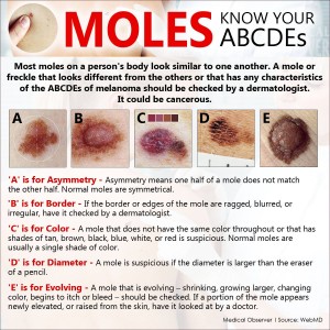 Moles Know Your ABCDEs - StudyPK