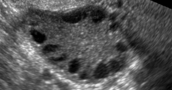 ARDMS Gynecology Review Questions: Quiz 98 - StudyPK