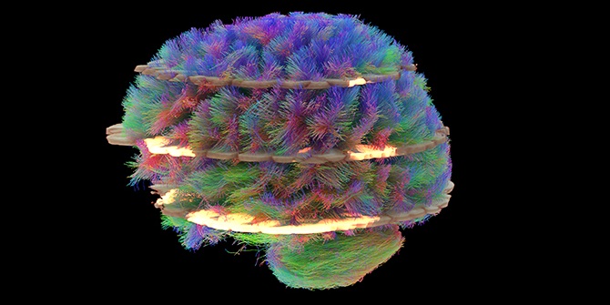 Siemens Simultaneous Multi-Slice MRI Technology for Fast Brain Scans ...