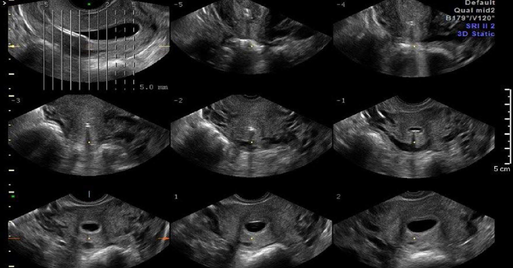 The current status of 3D USG in gynaecology - StudyPK