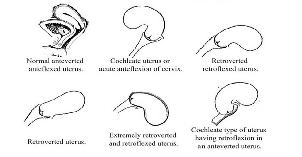 Retroverted Retroflexed Uterus Retroflexed Vs