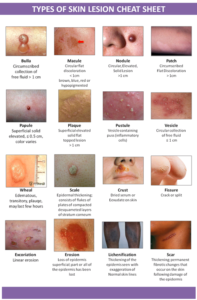 Types of Skin Lesion - StudyPK