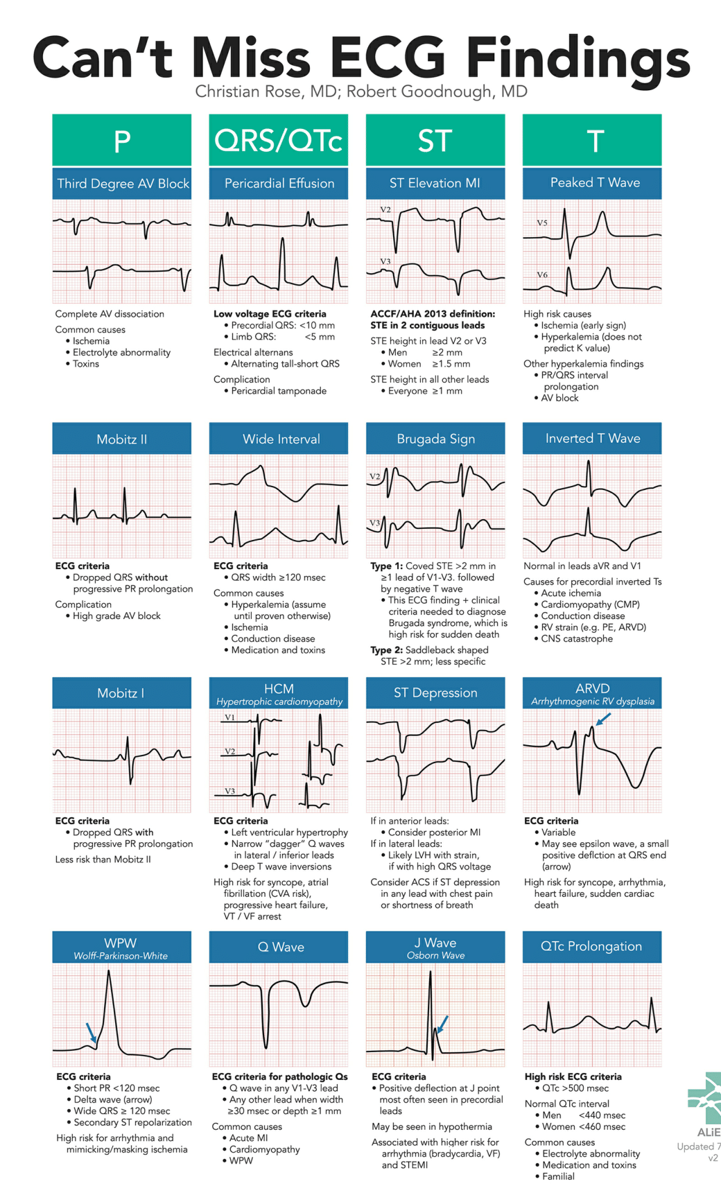 Can’t Miss ECG Findings Cards for the Emergency Medicine Provider - StudyPK