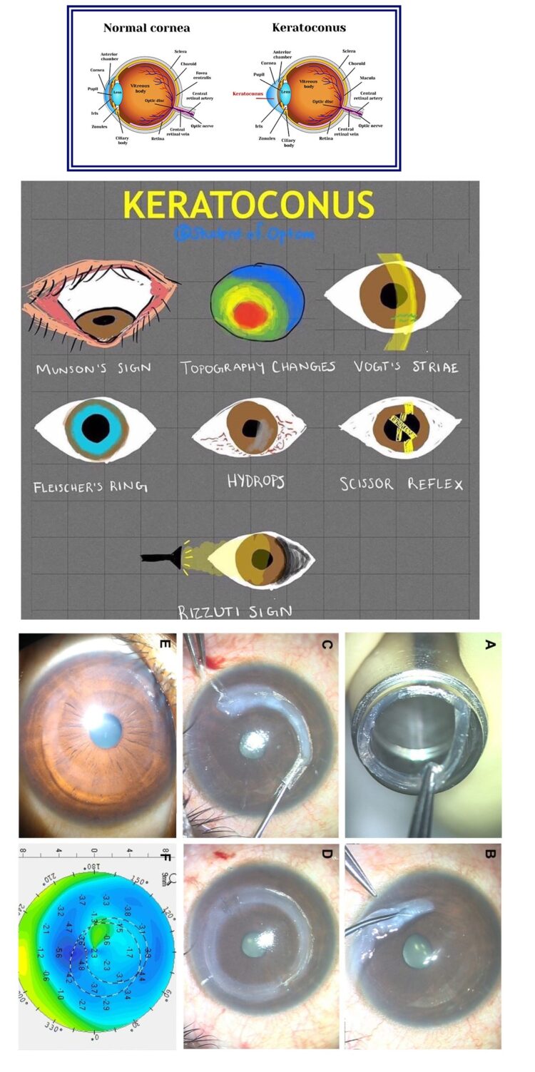 Normal Cornea vs Stages of Keratoconus Cheat Sheet - StudyPK