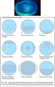 Superficial Punctate Keratitis - Eye Disorders - StudyPK