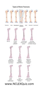 Types of Bone Fractures - StudyPK